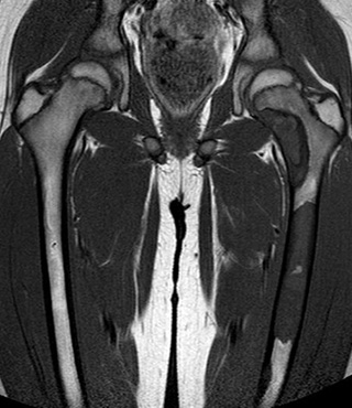 Fibröz Displazi | Türk Manyetik Rezonans Derneği Manyetik Rezonans MR