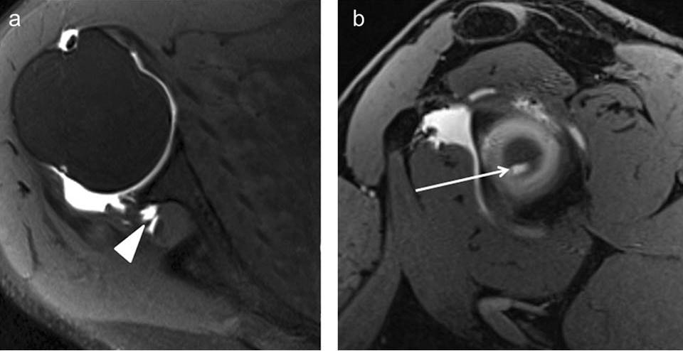 Paraglenoid labral kistle ilişkili posterior labral yırtık | Türk ...