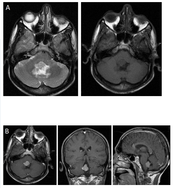 Koroid Pleksus Papillomu | Türk Manyetik Rezonans Derneği Manyetik ...