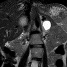 MEN IIA ile birlikte olan feokromositoma | Türk Manyetik Rezonans ...