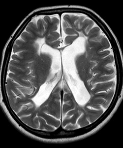 Periventriküler Lökomalazi | Türk Manyetik Rezonans Derneği Manyetik ...