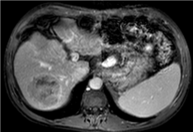Hepatoselüler Karsinom (HSK) | Türk Manyetik Rezonans Derneği Manyetik ...