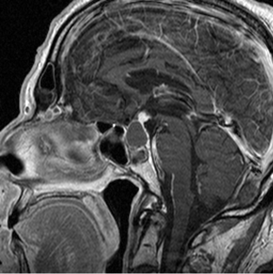 İntrasellar Kraniofaringioma | Türk Manyetik Rezonans Derneği Manyetik ...