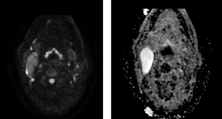 Brankial kleft kisti tip 2 | Türk Manyetik Rezonans Derneği Manyetik ...